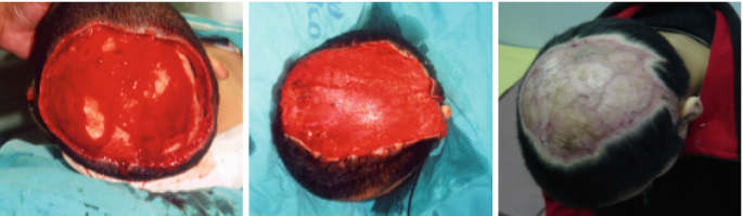 Fundamental of Scalp: Anatomy and Reconstruction | SpringerLink