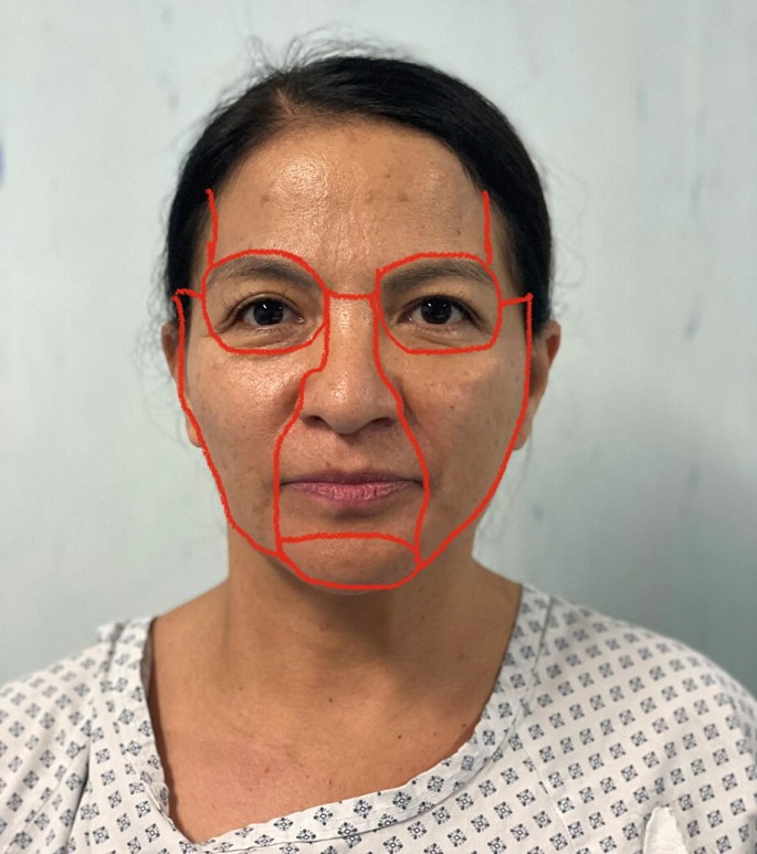 Fundamentals of Cheek Reconstruction | SpringerLink