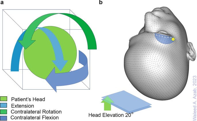Fully Endoscopic Supraorbital Approach for Anterior Cranial Base ...