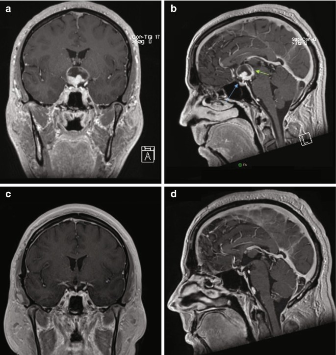 Endoscopic Supraorbital Translaminar Approach | SpringerLink