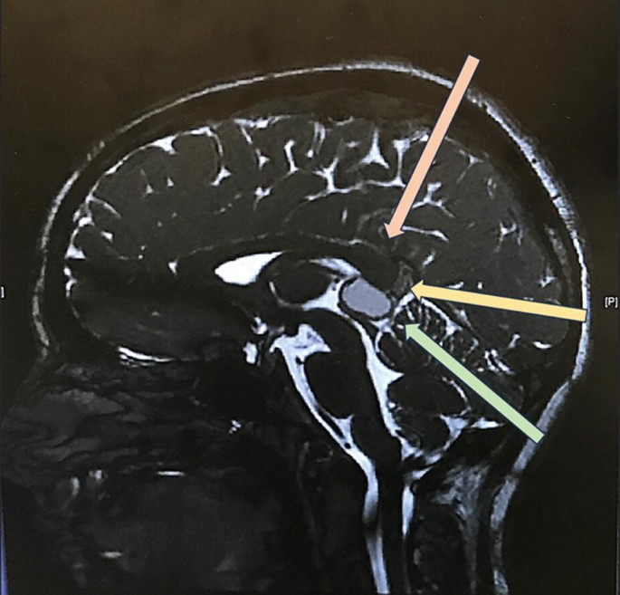 Purely Endoscopic Supracerebellar Infratentorial Approach to the Pineal ...