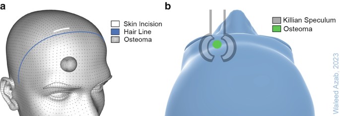 Fully Endoscopic Resection of Frontal Osteomas | SpringerLink