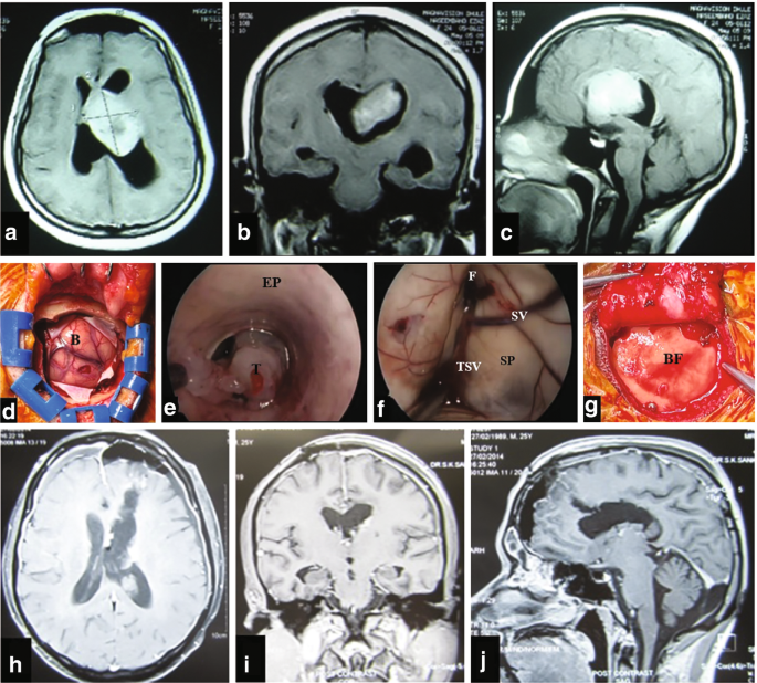 Endoport-Guided Endoscopic Excision of Intraaxial Brain Tumors ...