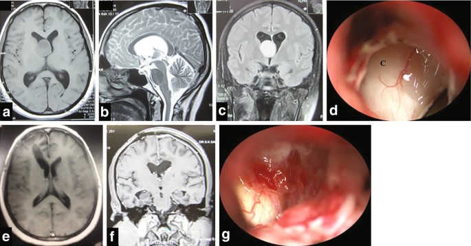 Endoport-Guided Endoscopic Excision of Intraaxial Brain Tumors ...