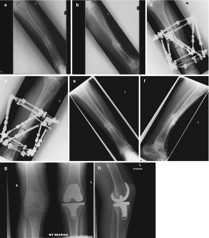 Tibial Alignment | SpringerLink