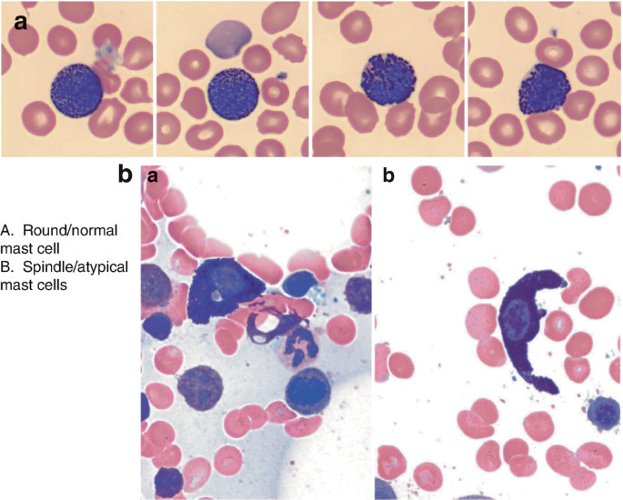 Benign Basophil and Mast Cell Disorders | Springer Nature Link