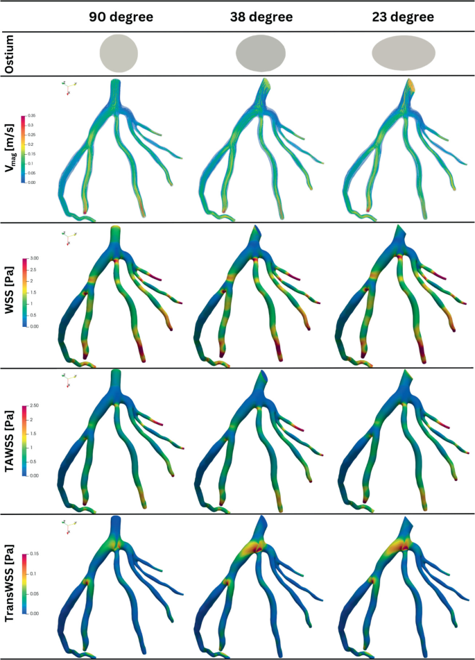 Patient-Specific In-Silico Hemodynamic Analysis of the Anomalous Aortic ...