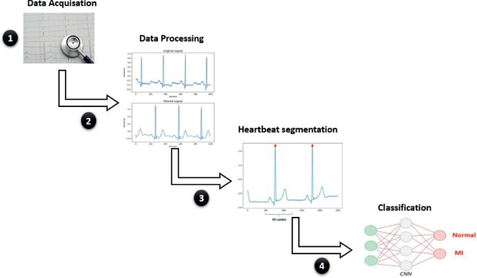 Automated ECG Classification for Myocardial Infarction Diagnosis Using CNN and Wavelet Transform ...