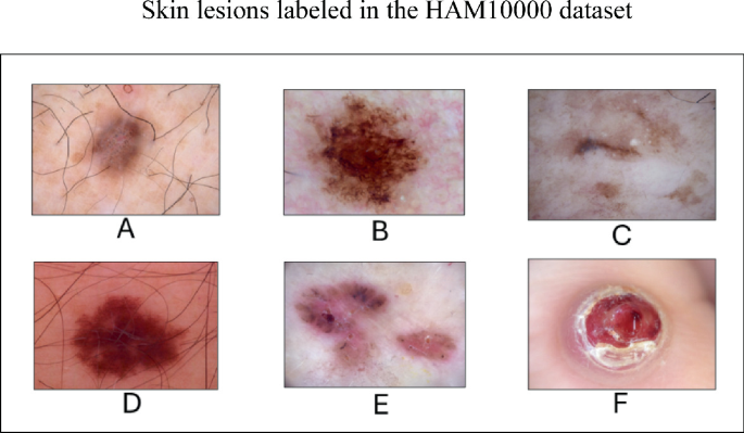 Comparison of CNNs and ViTs for the Detection of Human Skin Lesions ...