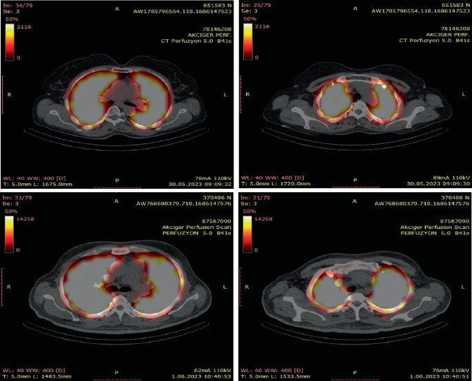 Automated Detection of Pulmonary Embolism Using CT and Perfusion Spectral Images | SpringerLink
