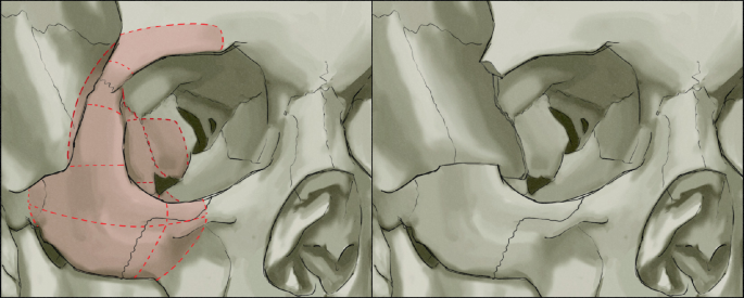 Lateral Approaches to the Orbit | SpringerLink