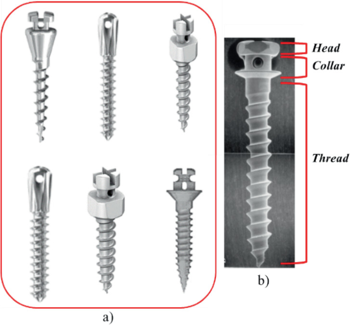 Overview of Mini-screws in Orthodontics | SpringerLink