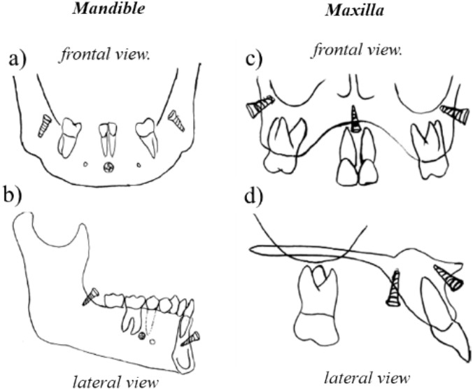 Overview of Mini-screws in Orthodontics | SpringerLink