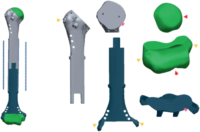 Modular Prosthesis Design for Additive Manufacturing | SpringerLink