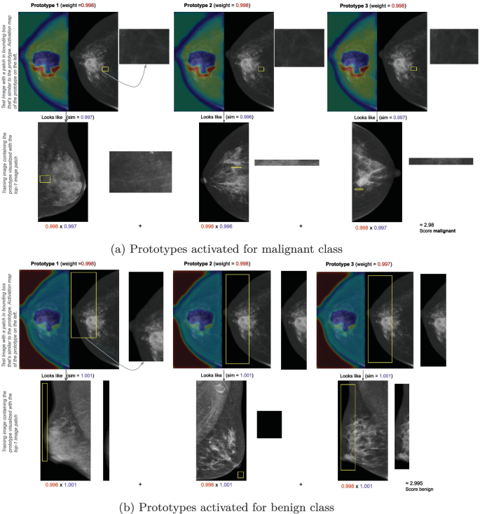 Prototype-Based Interpretable Breast Cancer Prediction Models: Analysis ...