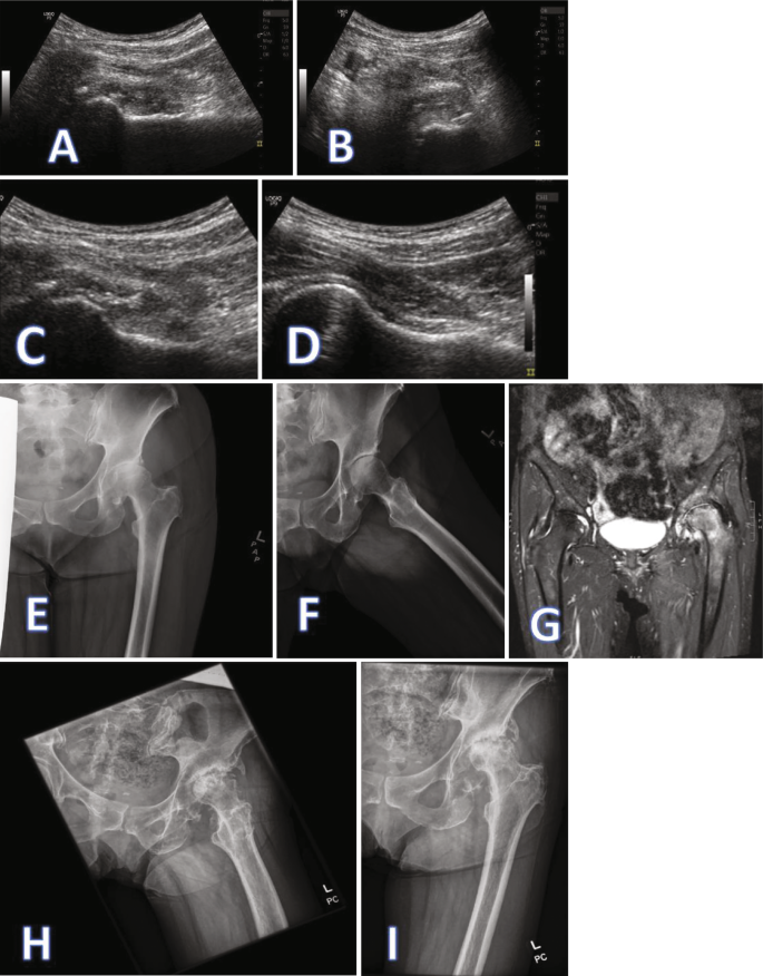 Ultrasonography of the Hip | SpringerLink