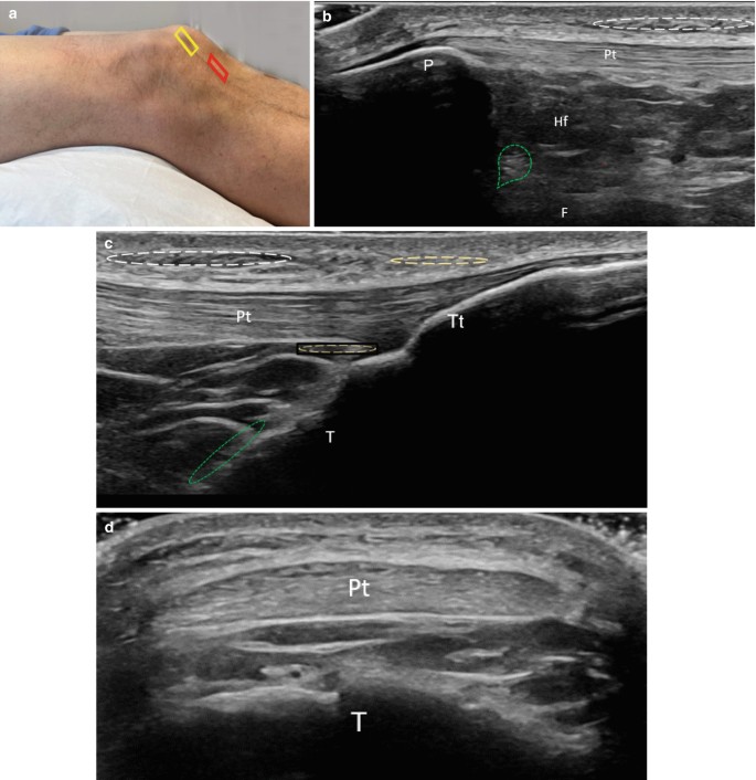 Ultrasonography of the Knee | SpringerLink