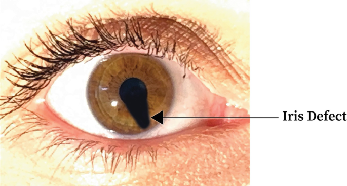 The Colored Iris Implants | Springer Nature Link