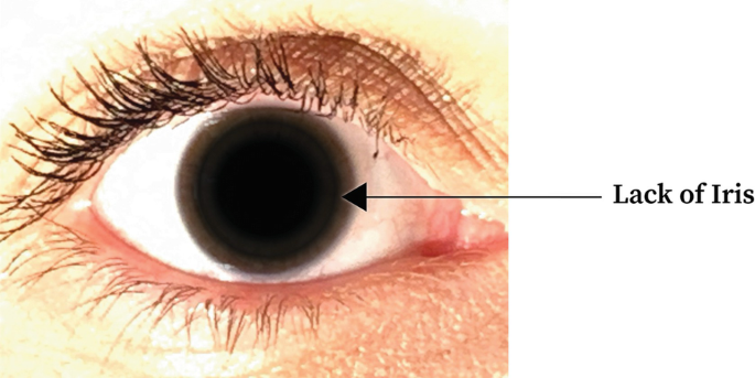 The Colored Iris Implants | SpringerLink