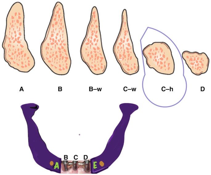 Implant-Retained (IROD) and Implant-Supported Overdenture (ISOD ...