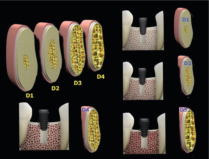 Implant Placement for IROD and ISOD | Springer Nature Link