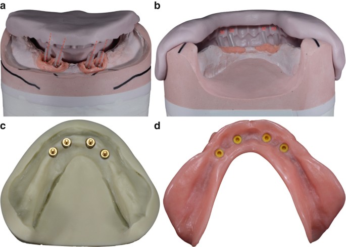 Implant Overdenture Fabrication with Different Attachments | Springer ...