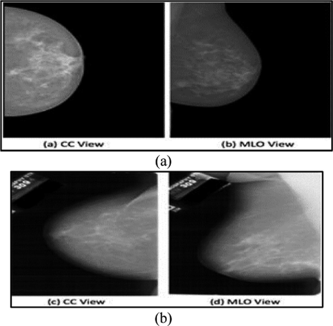 Biomedical Mammography Image Classification Using Patches-Based Feature Engineering with Deep ...
