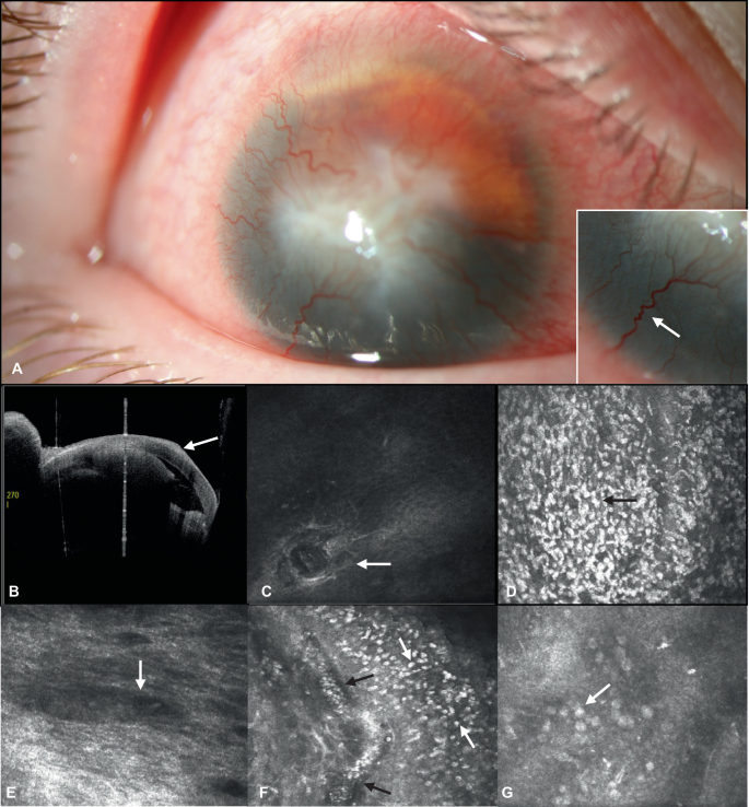 Aniridia-Associated Keratopathy AAK—Genotype and Phenotype | Springer ...
