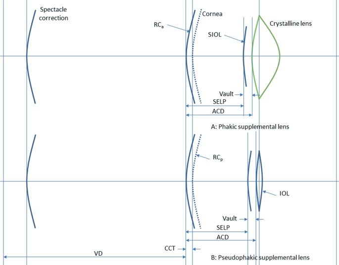 Optics and Impact on IOL Power Calculation | Springer Nature Link ...