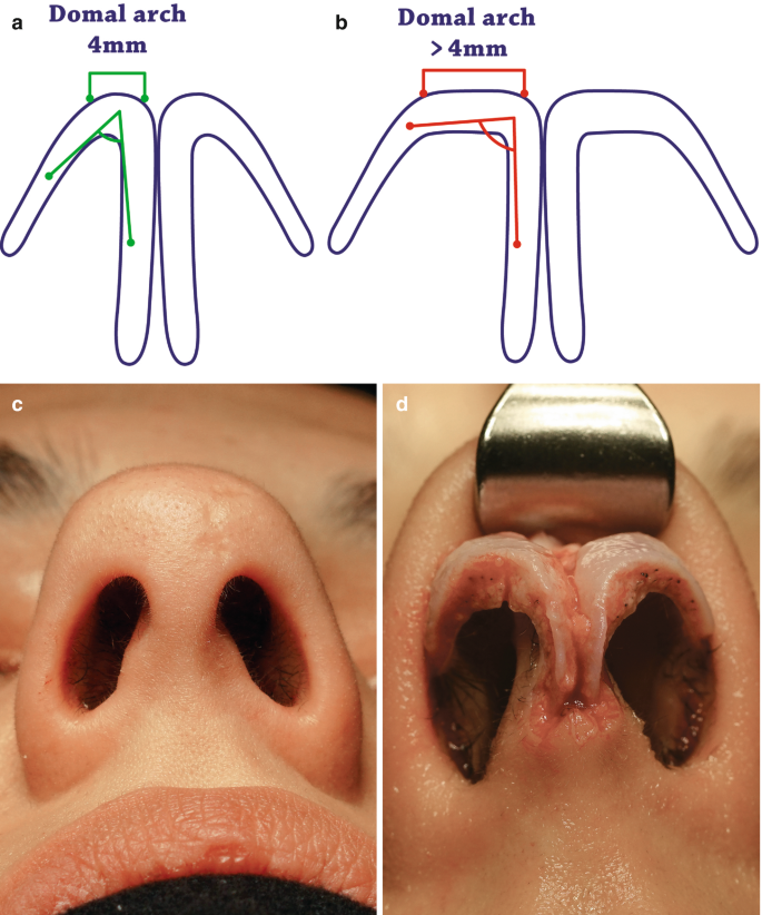 Wide Nasal Tip | SpringerLink