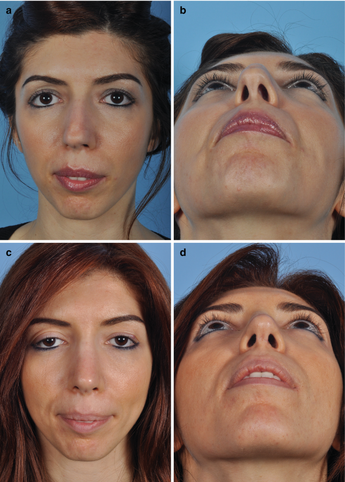 Asymmetrical Nasal Tip | SpringerLink