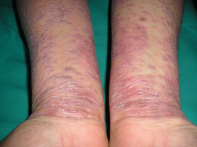 Lichen Planus and Lichenoid Dermatoses | SpringerLink