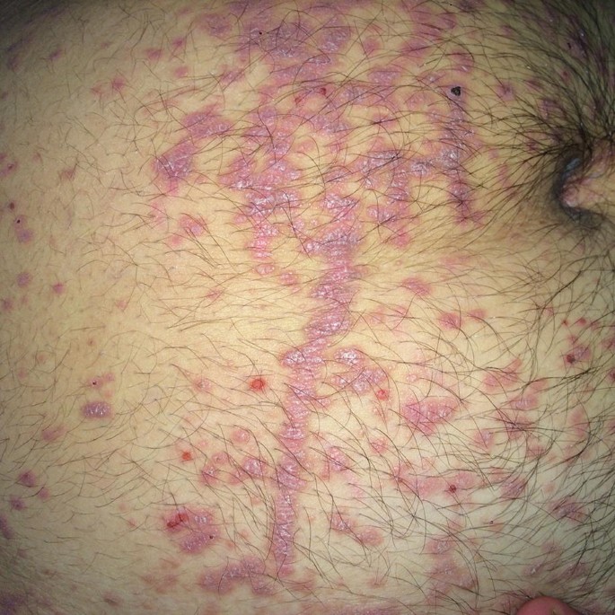 Lichen Planus and Lichenoid Dermatoses | SpringerLink