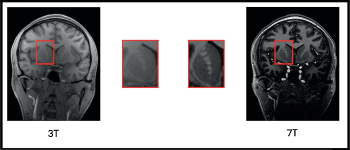 3T to 7T Whole Brain + Skull MRI Translation with Densely Engineered U ...