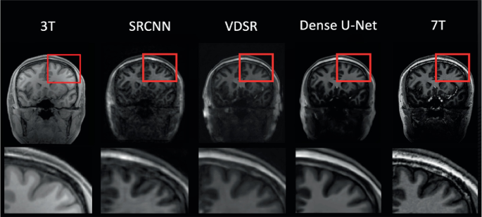 3T to 7T Whole Brain + Skull MRI Translation with Densely Engineered U ...