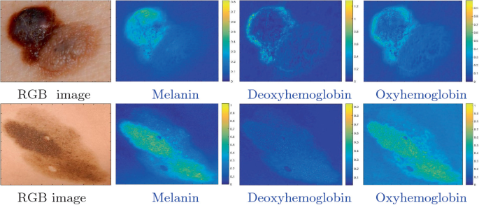 Identification of Skin Diseases Based on Blind Chromophore Separation ...