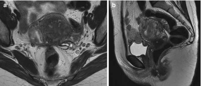 Deep Infiltrating Endometriosis | SpringerLink