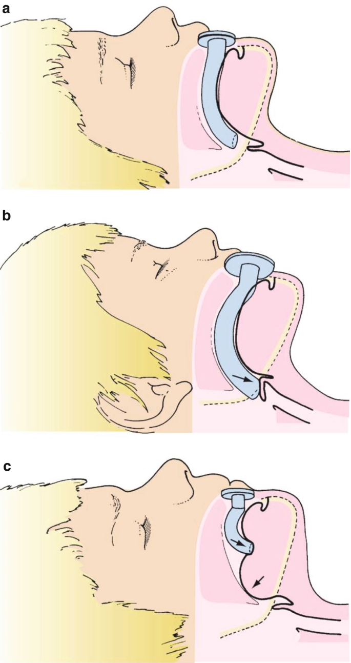 The Pediatric Airway: Anatomy, Challenges, and Solutions | SpringerLink