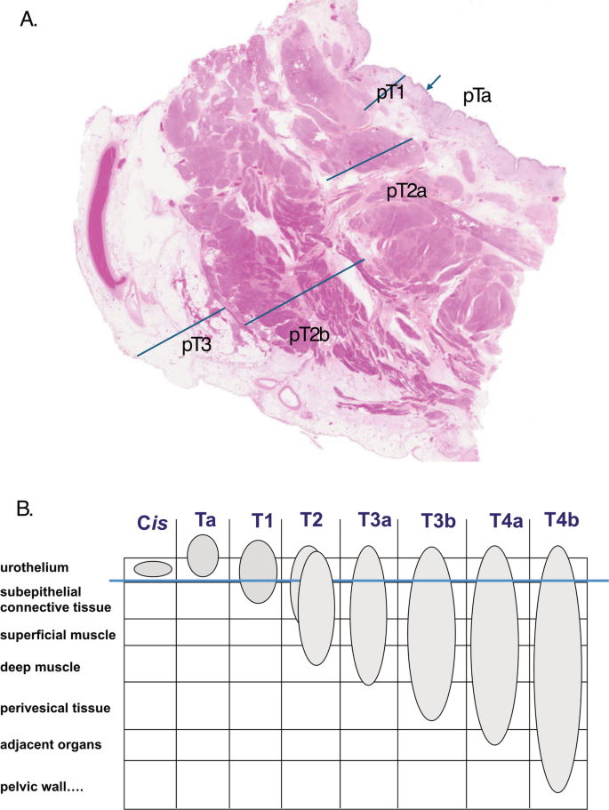 Bladder Cancer Pathology | SpringerLink