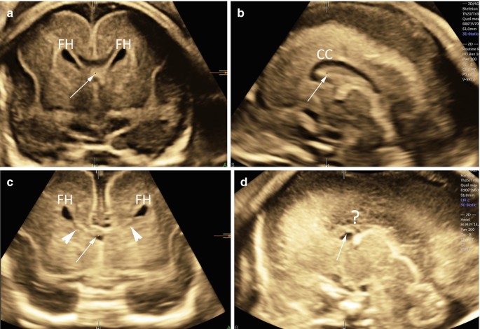 Anomalies of the Cavum Septi Pellucidi (CSP) | SpringerLink