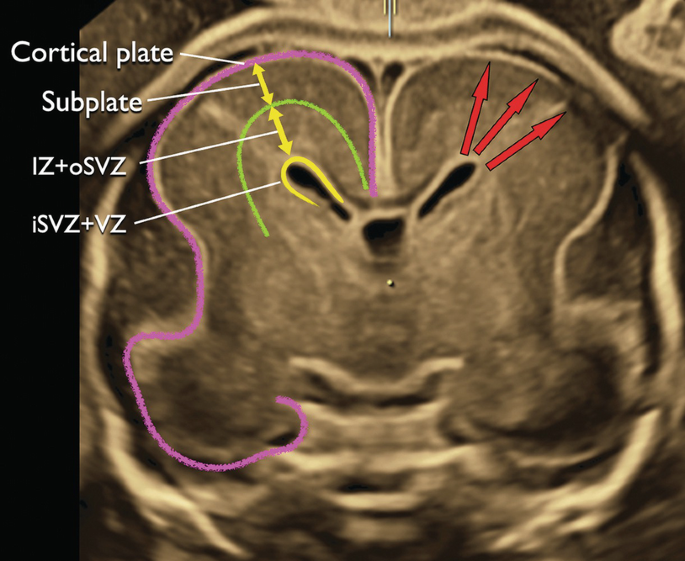 Malformations of Cortical Development (MCDs) | SpringerLink