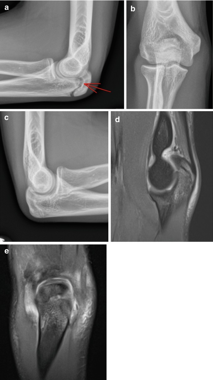 Physeal Stress Injuries of the Elbow | SpringerLink