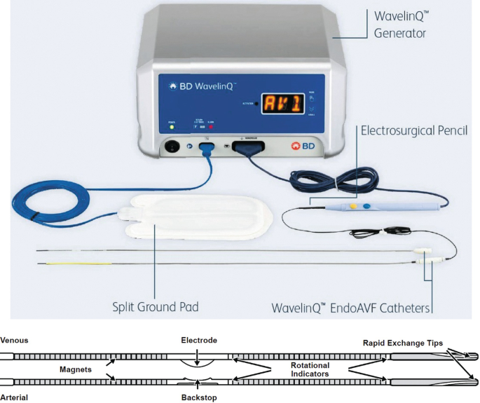 Endovascular Fistula Creation | SpringerLink