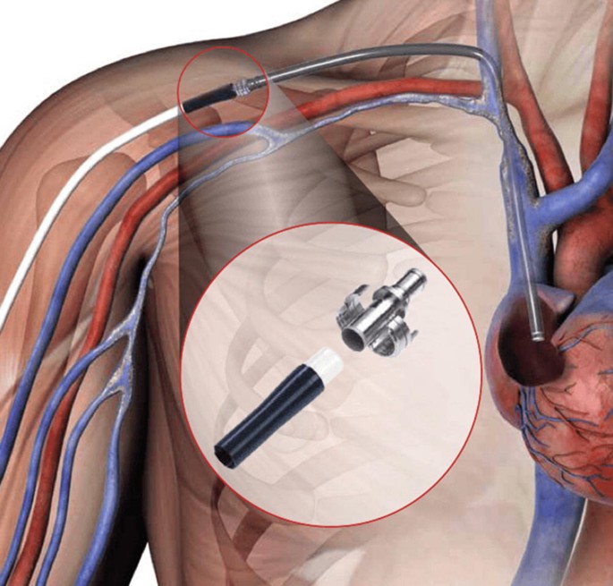 The HeRO Graft | SpringerLink