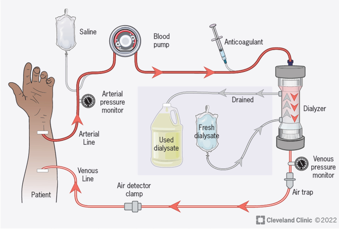 Principles of Hemo- and Peritoneal Dialysis | SpringerLink