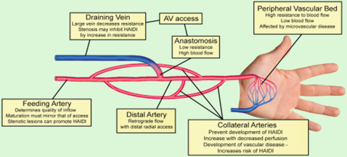 Hemodialysis Access-Induced Distal Ischemia (HAIDI) | SpringerLink