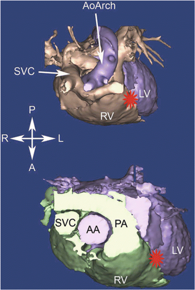 Attitudinally Correct Cardiac Anatomy | SpringerLink