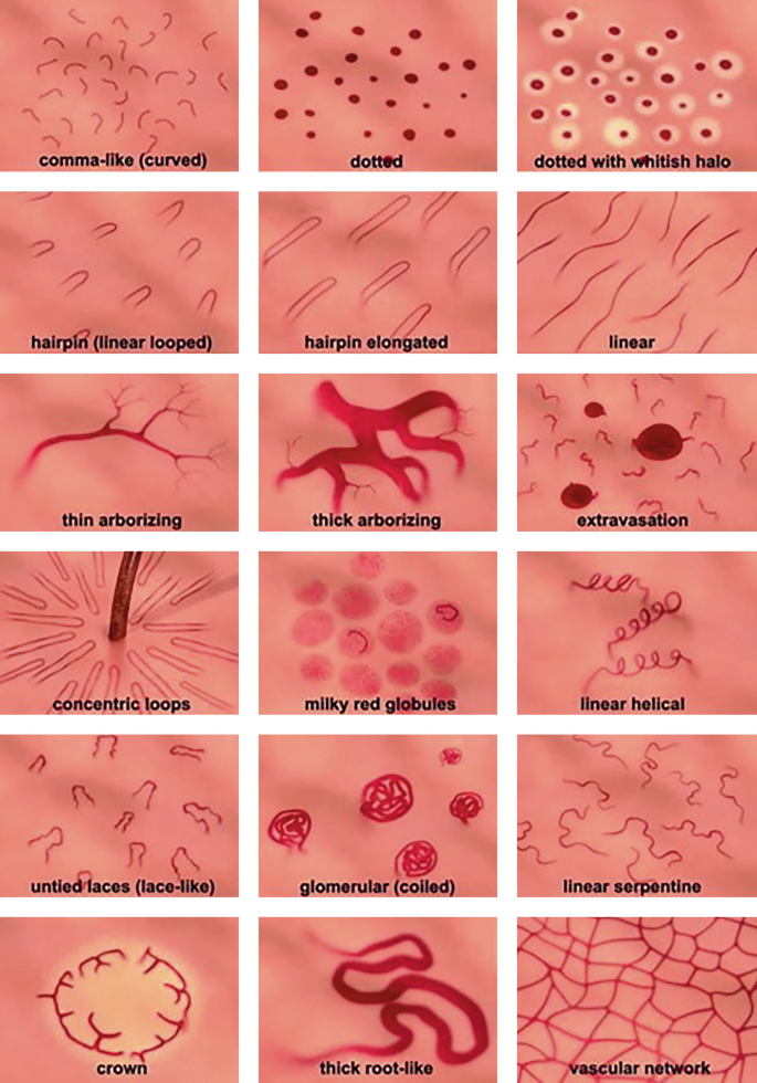 Dermoscopy and Electron Microscopy | SpringerLink