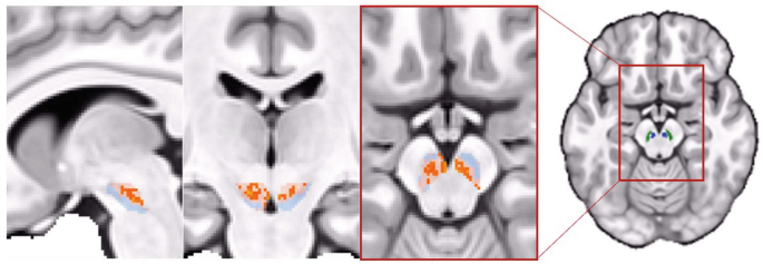 Dopamine Mechanisms and Neuromelanin-Sensitive Magnetic Resonance ...