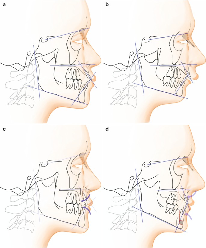 C3—Bimaxillary Protrusion and Dental Proclination Versus Bi-Alveolar ...
